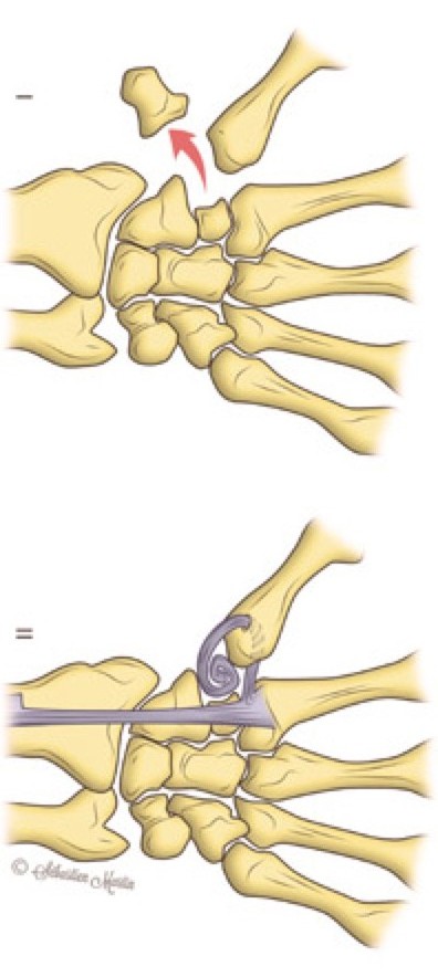Arthrose du pouce ou Rhizarthrose - Alès ChirOrtho
